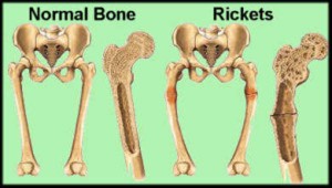 Rickets: Types, symptoms and treatments - GOQii